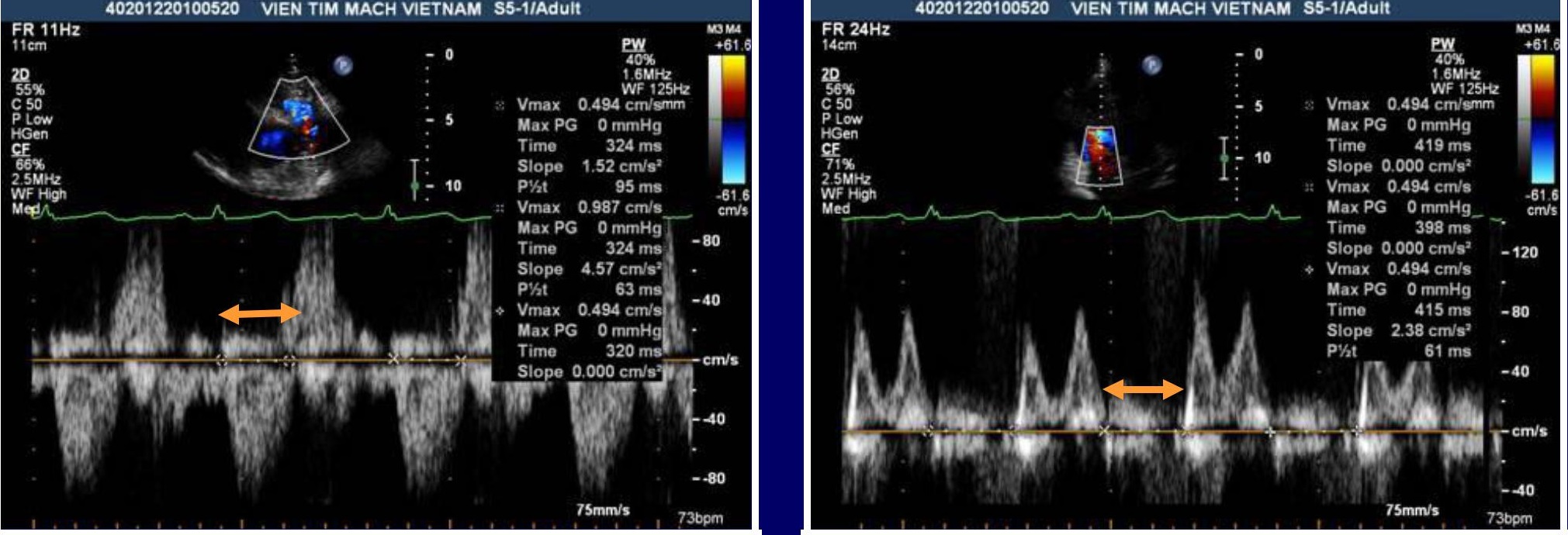 [Hội nghị tim mạch VIII] Siêu âm Doppler tim đánh giá chức năng thất ...