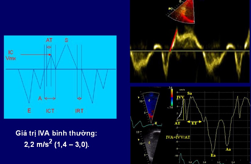 [Hội nghị tim mạch VIII] Siêu âm Doppler tim đánh giá chức năng thất ...