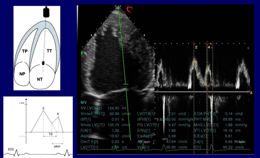 [Hội nghị tim mạch VIII] Siêu âm Doppler tim đánh giá chức năng tâm ...